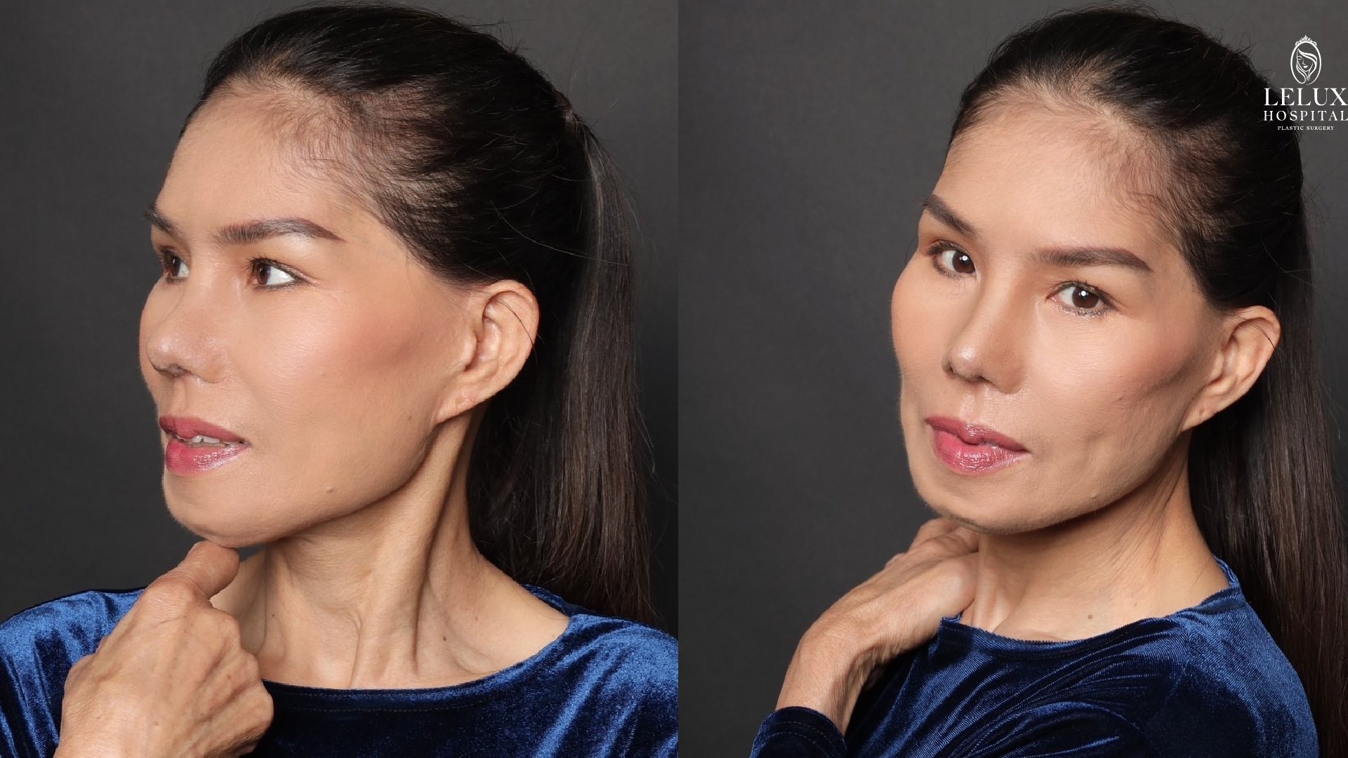 ศัลยกรรมแก้จมูกพัง พลิกชีวิต กับ คุณมันนี่ - โรงพยาบาลเลอลักษณ์ (Lelux ...