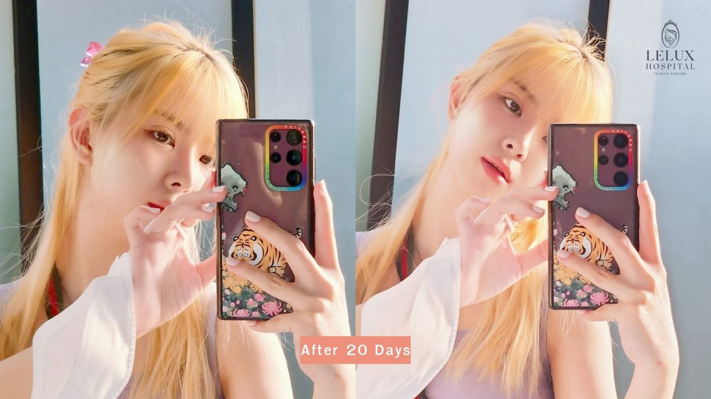 แก้ปัญหาชั้นตาหลุด 3 ปี กับสาวหมวย Cosplay คุณกุ๊กไก่ Misaki Chan ...