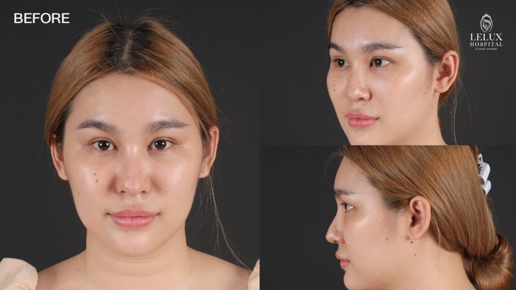 ศัลยกรรมแก้จมูก เปลี่ยนใบหน้าคุณไลลา PR สาวให้สวยดุจเจ้าหญิง ...