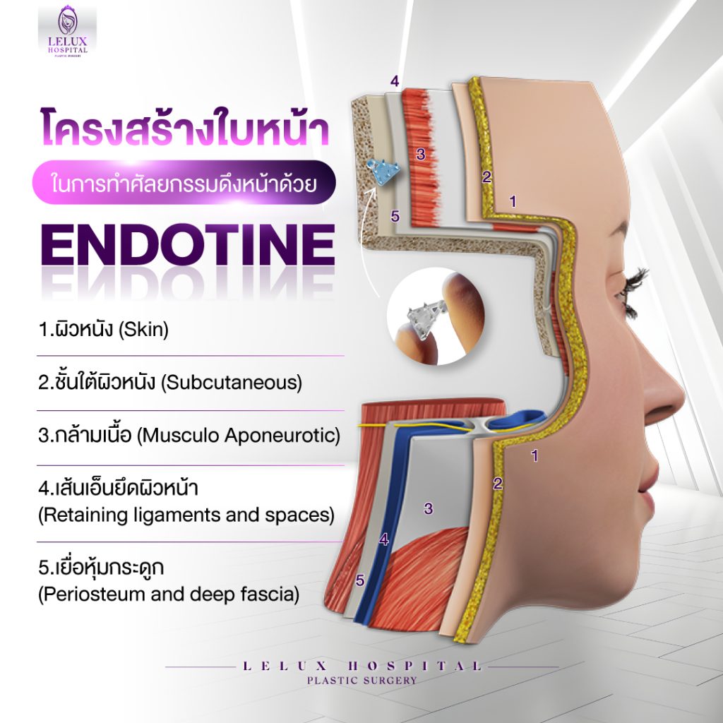 ศัลยกรรมดึงหน้า ยกคิ้ว Endotine - โรงพยาบาลเลอลักษณ์ (Lelux Plastic ...
